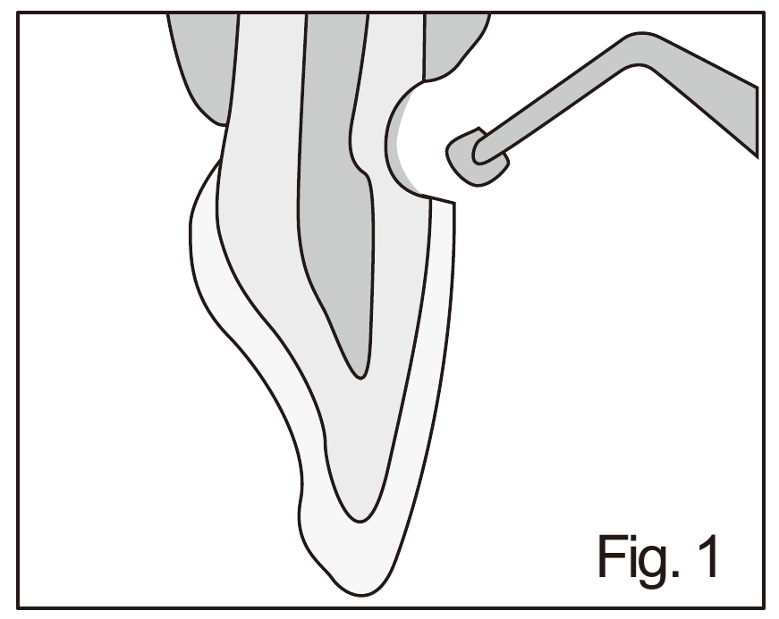 GC CORPORATION Fuji II LC CAPSULE - Radiopaque Light Cured Glass ...