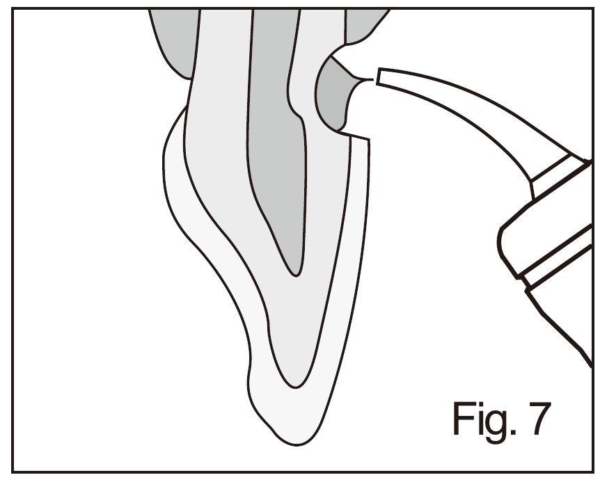 GC CORPORATION Fuji II LC CAPSULE - Radiopaque Light Cured Glass ...
