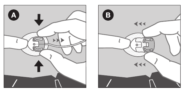 Tandem AutoSoft 90 - Infusion Set Manual | ManualsLib