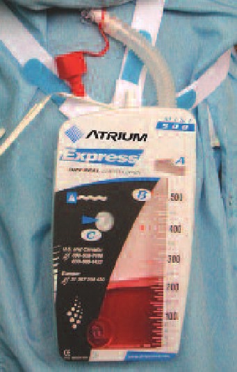 Atrium Express Mini 500 - Dry Seal Chest Drain Patient Manual and Video ...