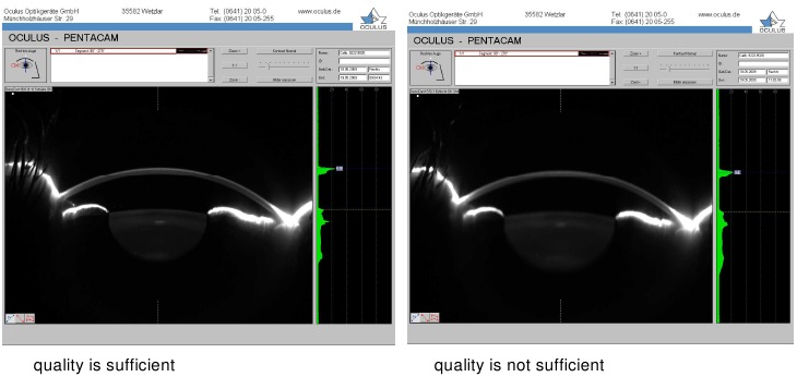 OCULUS Pentacam, PentacamHR Manual | ManualsLib