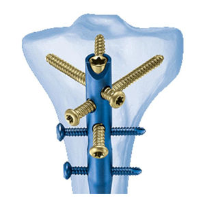 SYNTHES EXPERT TIBIAL NAIL TECHNIQUE MANUAL Pdf Download | ManualsLib